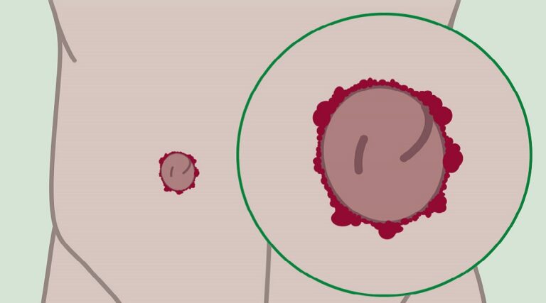 Stoma und Ernährung: Expertenrat für Betroffene