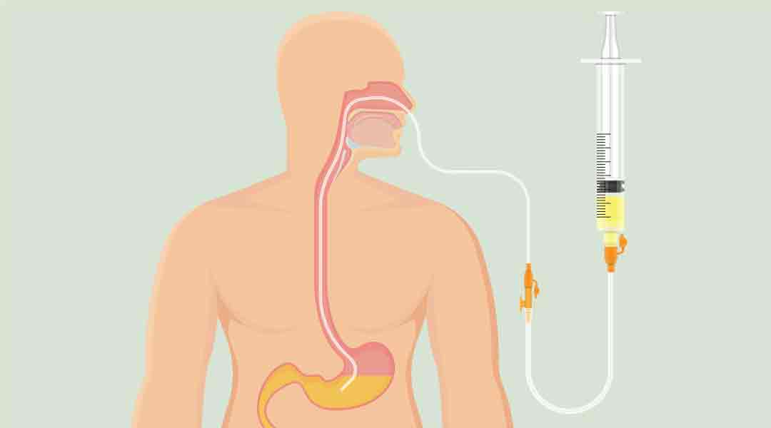Sondennahrung - GHD GesundHeits GmbH Deutschland