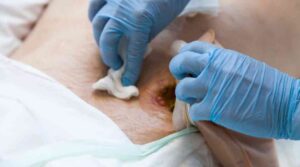 Wie kann man Stoma Komplikationen vorbeugen und behandeln?