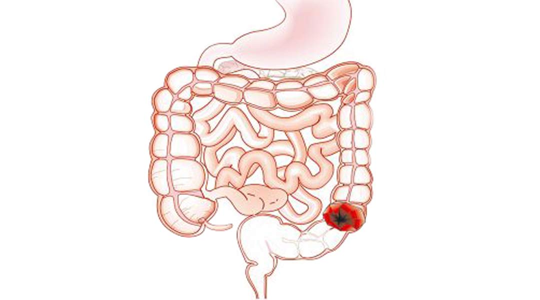 Kolostomipose Modell