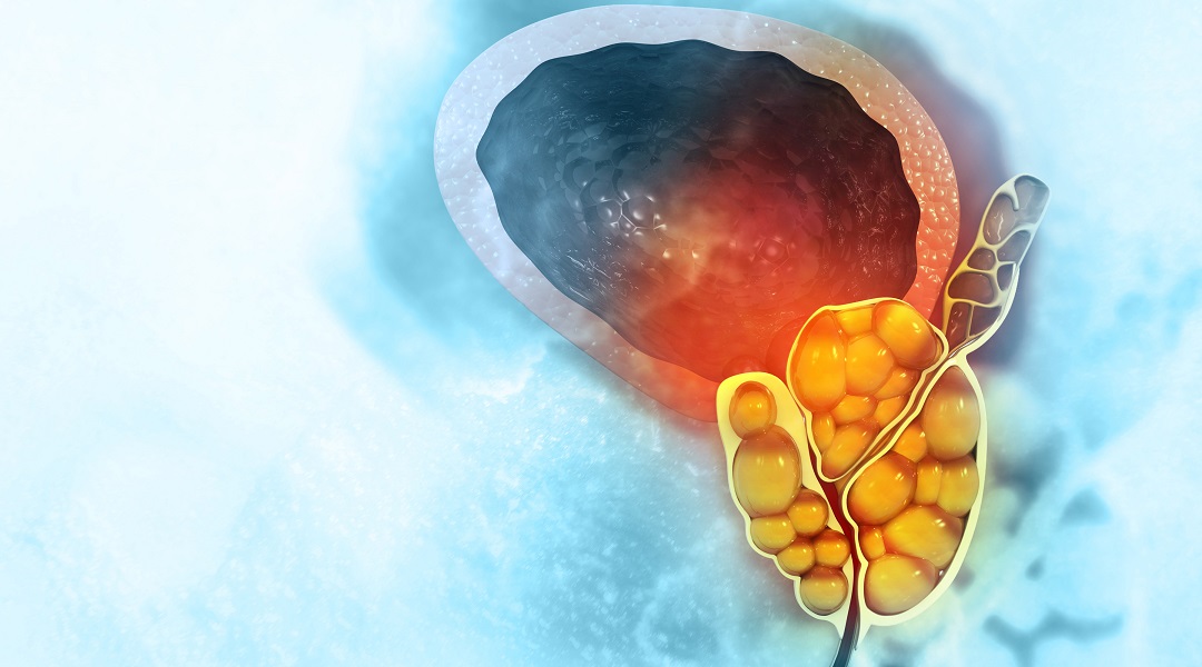 Blasensteine - GHD GesundHeits GmbH Deutschland